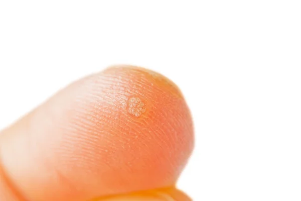 Verruca Stock Photos, Royalty Free Verruca Images | Depositphotos