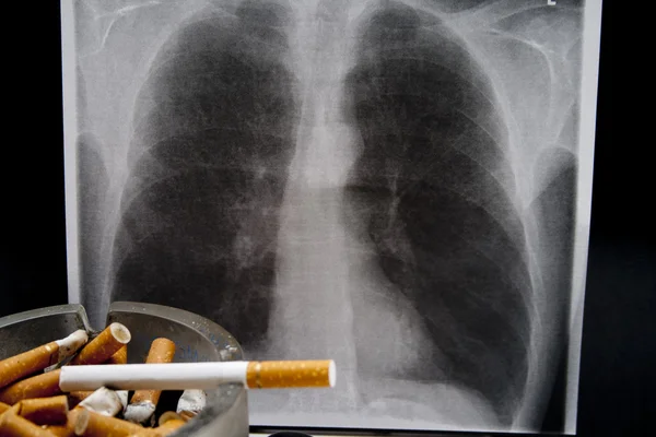 RTG snímek plic kuřáka — Stock fotografie #11161570