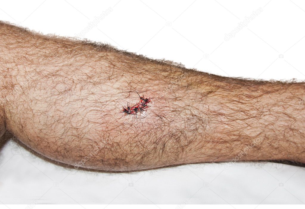 Stitches Stock Photo by ©ekays 12108325